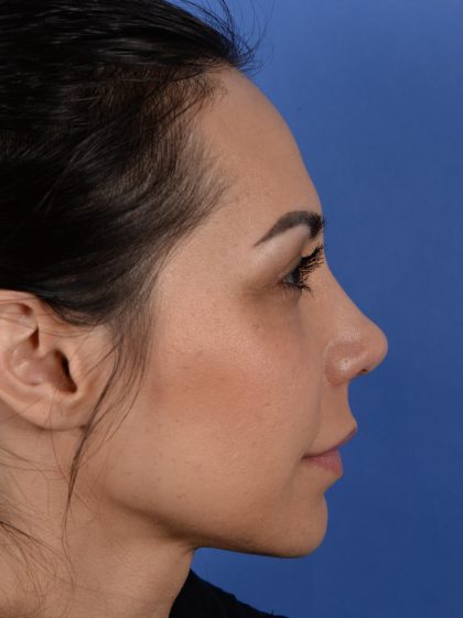Patient #3019 Revision Rhinoplasty Before and After Photos Englewood ...